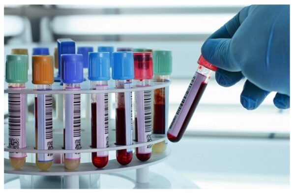 Blood Specimen Collection : Processing, Importance, Procedure ...