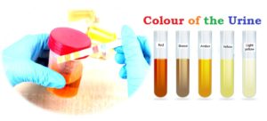 Physical Examination of Urine - MedicoInfo