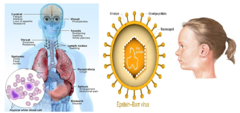 Infectious mononucleosis - MedicoInfo