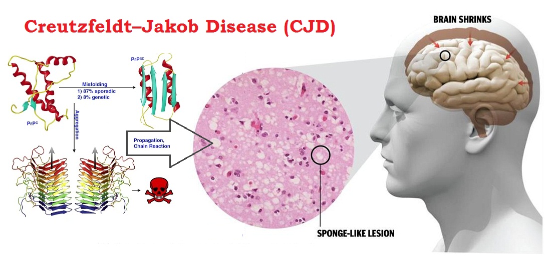 Creutzfeldt–Jakob Disease (CJD) : Sign and Symptoms, Risk factors ...