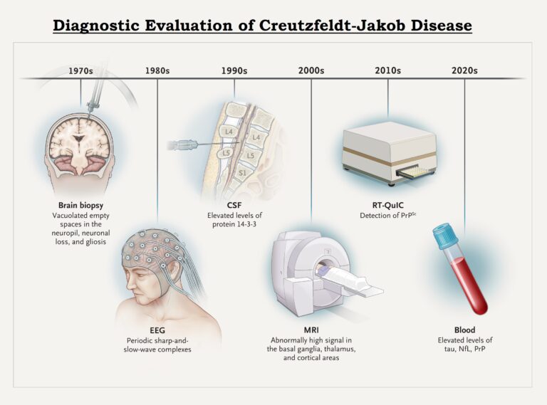 Creutzfeldt–Jakob Disease (CJD) : Sign and Symptoms, Risk factors ...